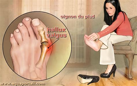 Hallux valgus définition et explications