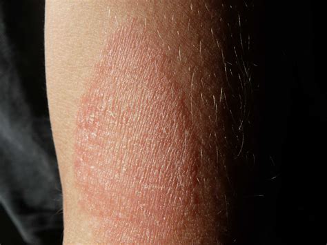 Conheça os principais tipos de dermatite e aprenda a diferenciá los