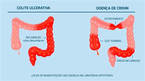 Doen A Inflamat Ria Intestinal Observaped