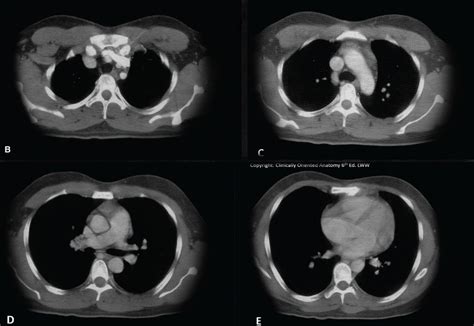 Greyscale Thoracic CT Scan Diagram Quizlet