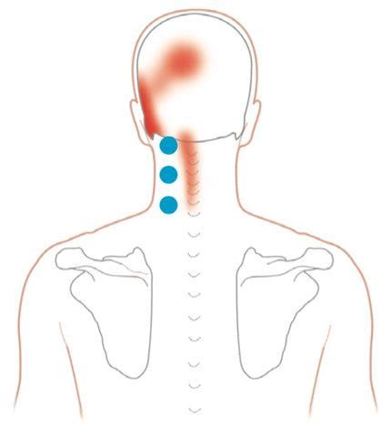 Shoulder Pain And Stiffness Treating Infraspinatus Artofit