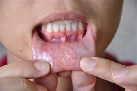 Câncer de Boca é tema de semana especial de prevenção aprenda como se