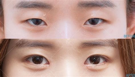 Korean Artist Plastic Surgery Before And After