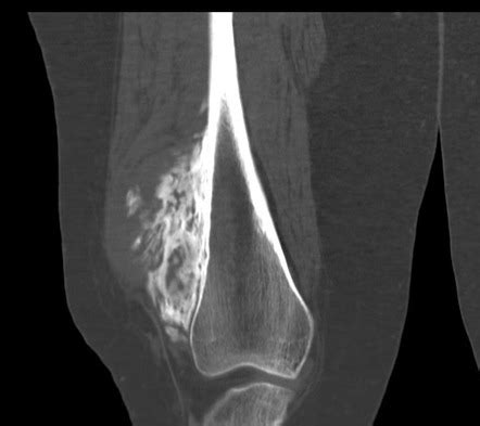 Parosteal Osteosarcoma Mri