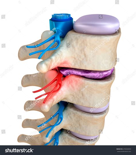 6 733 Damaged Discs Images Stock Photos Vectors Shutterstock