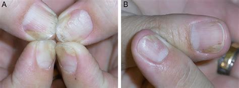Further Development Of The Nail Psoriasis Notes A After Continued Download Scientific