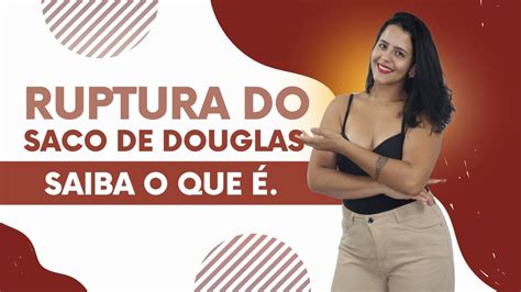 Ruptura do saco de Douglas Saiba o que é YouTube