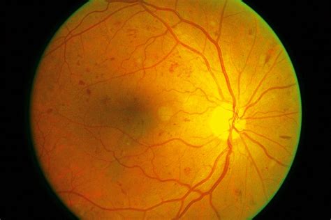 Moderate Non Proliferative Diabetic Retinopathy Microaneur Flickr