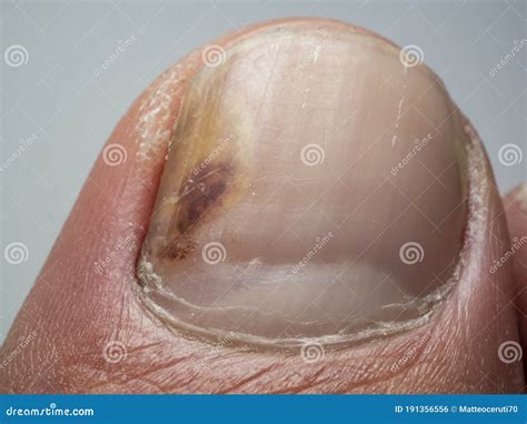 Infecciones De Uñas Causadas Por Hongos Como Onicomicosis También