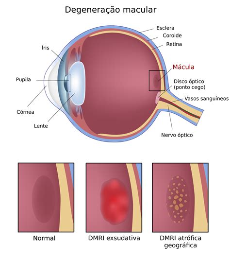 Degeneração Macular O que é sintomas e tratamento Conhecer para