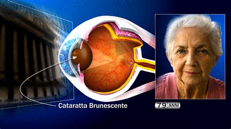 CATARATTA SENILE OCULISTICATV
