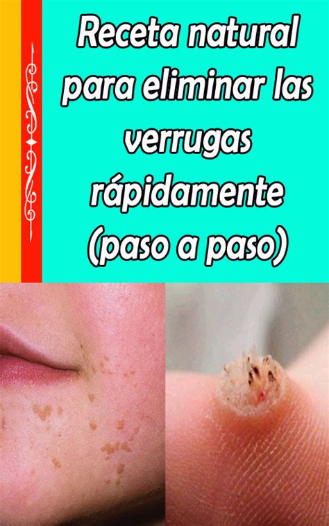 Receta natural para eliminar las verrugas rápidamente paso a paso