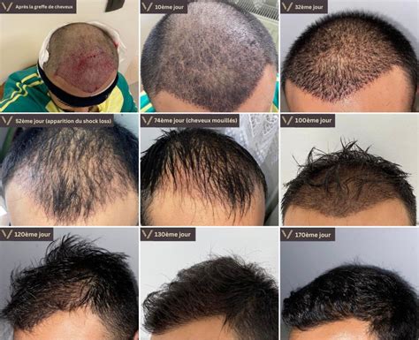 Chronologie De La Croissance De La Greffe De Cheveux Vantage