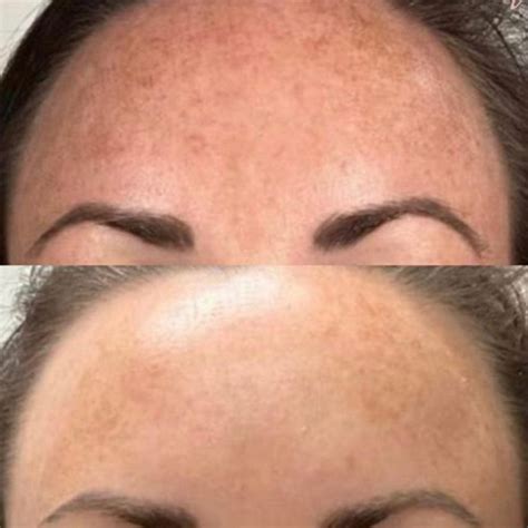 Laser Skin Resurfacing Types Effects Risks Cost