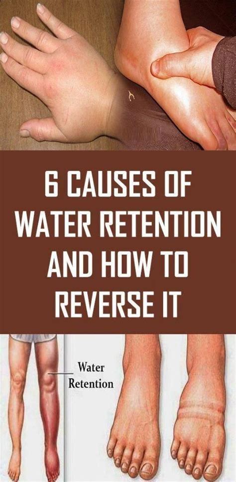 How To Treat Water Retention In Legs And Feet