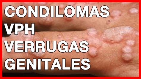 VPH Condilomas acumulados Y Verrugas genitales Síntomas y