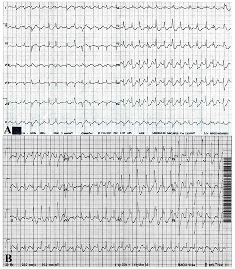 Monomorphic Vs Polymorphic Ventricular Tachycardia