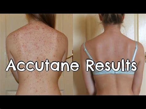Accutane Before And After Bacne