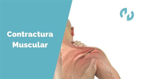 Contractura Muscular Youtube