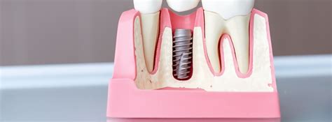 Cat Costa Un Implant Dentar