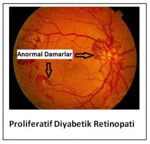 Diyabetik Retinopati Tedavisi Prof Dr G Khan G Lkilik