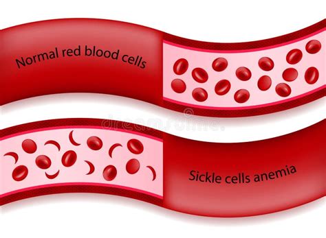 Normal Red Blood Cell And Sickle Cell Anemia Stock Vector