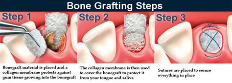Dental Implants 101 Part 3 North Texas Dental Surgery