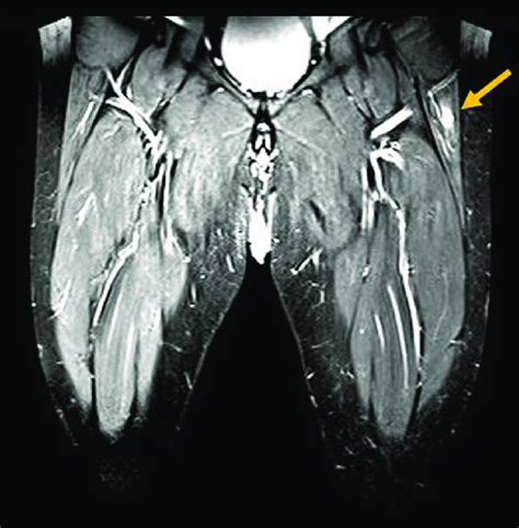 T2 Weighted Magnetic Resonance Imaging MRI With Contrast For Both