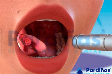 Cáncer oral Prevención causas y tratamiento Clínica Pardiñas