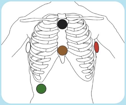 Telemetry Lead Placement Diagram