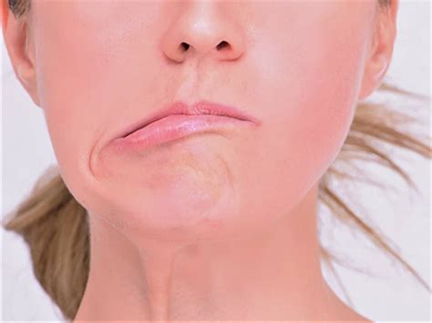 Tratamiento de la parálisis facial Síntomas y causas Logopedia y Más