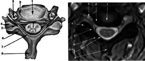 Cervical Spine Mri Labeled