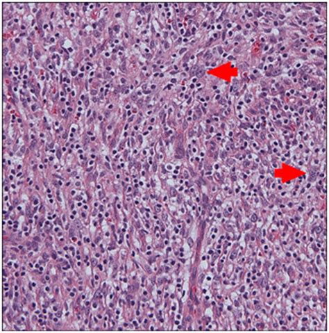 Follicular Dendritic Cell Sarcoma