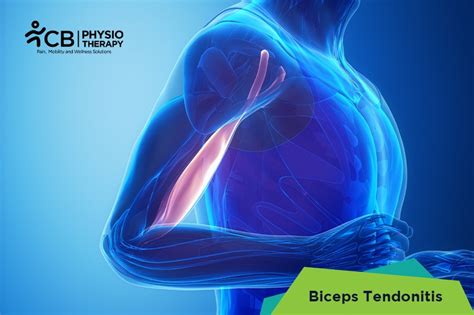 Top Exercises For Biceps Tendonitis Webp