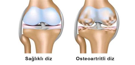 Kireçlenme osteoartrit nedir neden olur Belirtileri ve tedavisi