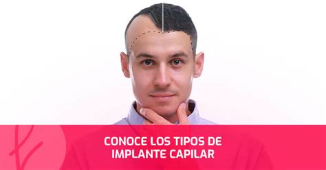 Conoce los Tipos de Implante Capilar Dr Edwin Vásquez en Lima