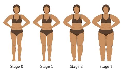 El Cuerpo De La Mujer En Diferentes Etapas De Lipedema Vector Premium