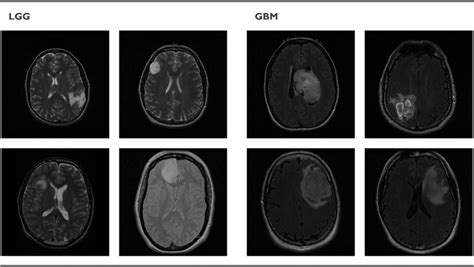 illustration of brain mr images belonging to lgg and gbm classes download scientific diagram