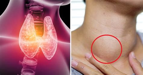 3 enfermedades que se esconden detrás del bocio cuando aparece un