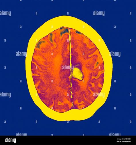 Brain Haemorrhage Coloured Computed Tomography CT Scan Of A Section