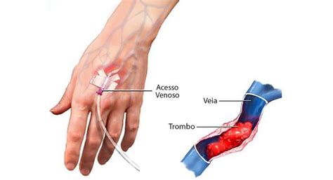 Flebite E Os Cuidados De Enfermagem