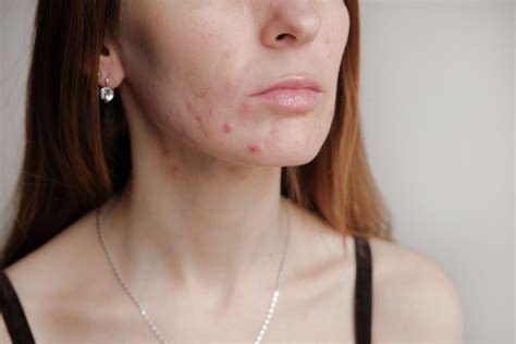 Saiba mais sobre acne na mulher adulta Spaço Saúde Life Estética e