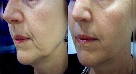 Cómo eliminar la flacidez del rostro de manera natural Aweita La