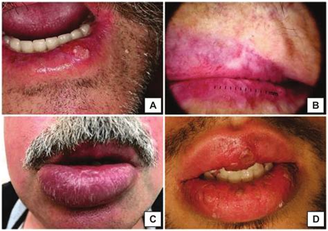 Mainly Irreversible Types Of Cheilitis A Actinic Cheilitis B