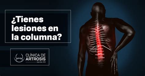 Tienes Lesiones En La Columna Clinica De Artrosis