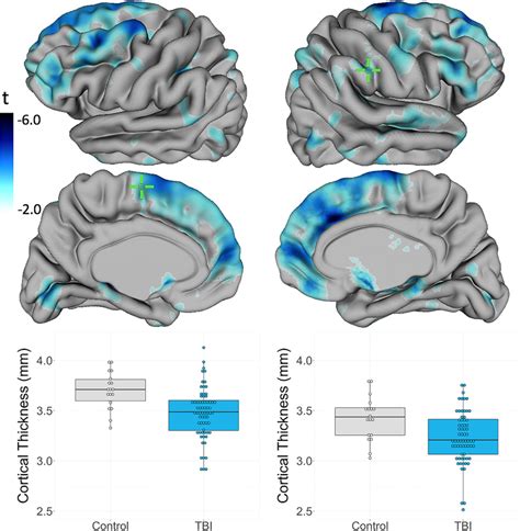 Differences In Cortical Thickness Between Control And Traumatic Brain