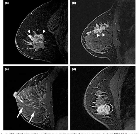 descriptors of malignant non mass enhancement of breast mri their correlation to the presence