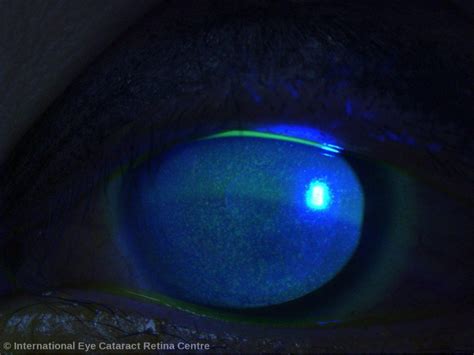 October Is Contact Lens Complications Awareness Month International