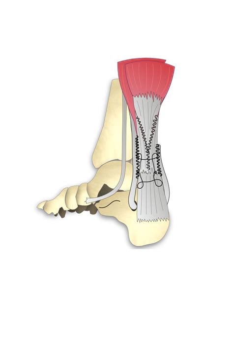 Rupture Ancienne Du Tendon D Achille Dr Bovier Lapierre