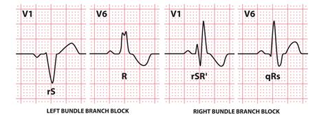Bundle Branch Block What Is It Causes Symptoms Treatment